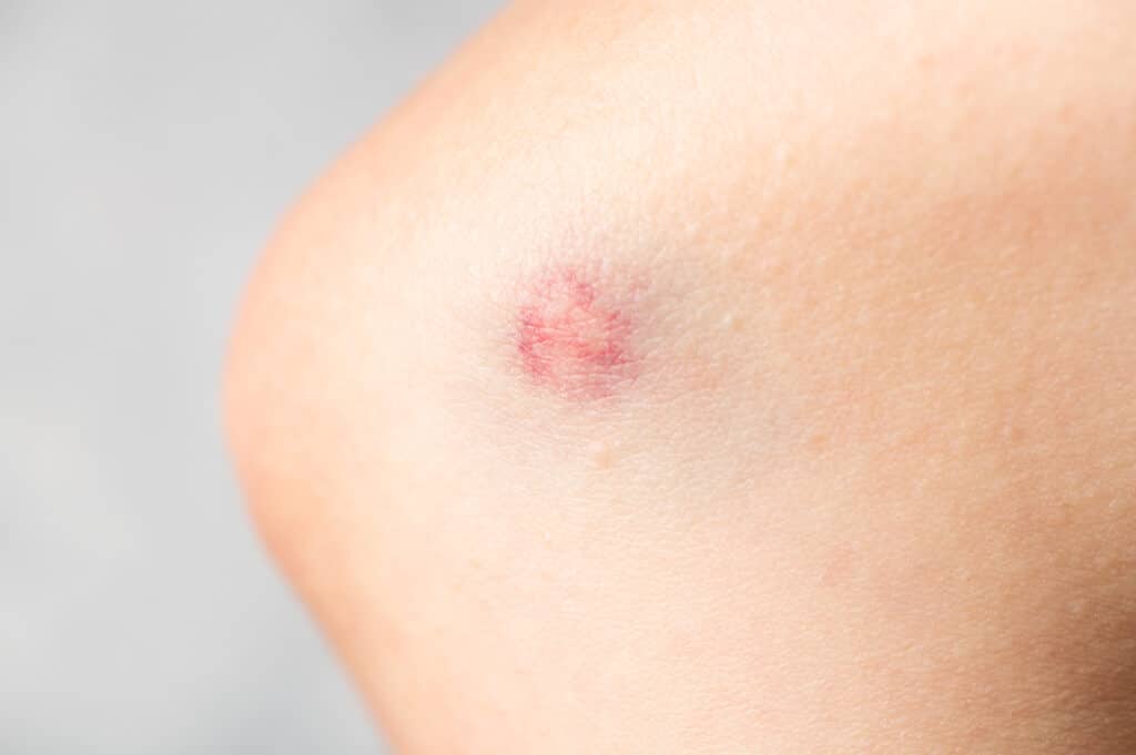 Most Painful Insect Bites & Stings - Symptoms & Causes